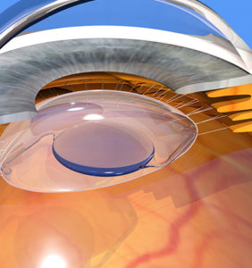 Advanced Cataract Procedures